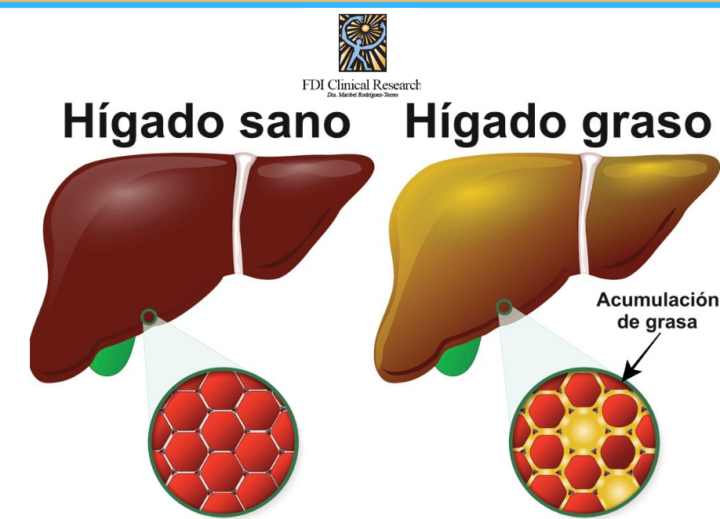 Fibroscan – FDI Clinical Research